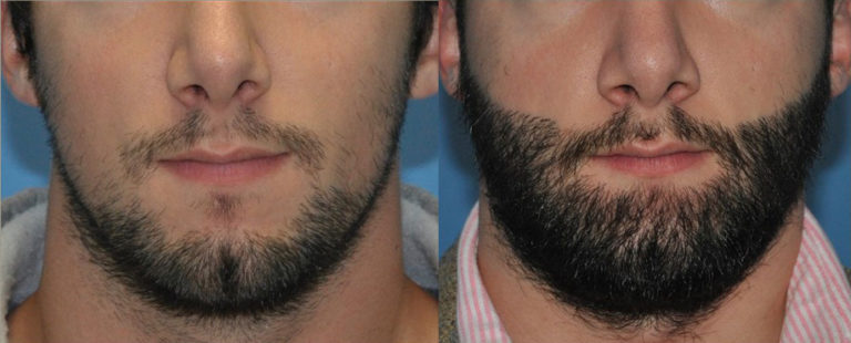 Facial Hair Restoration - Carolina Hair Surgery