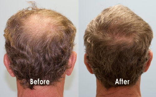 Crown (Vertex) Hair Restoration - Carolina Hair Surgery