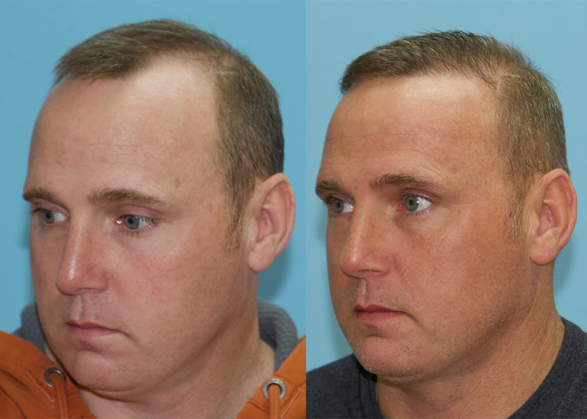 Front Forelock Hairline Restoration - Carolina Hair Surgery