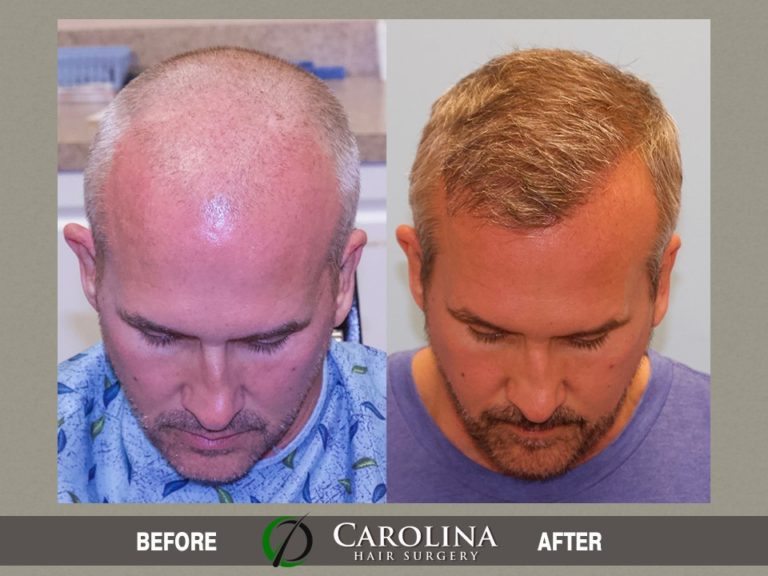Hair Transplant Before & After Photos