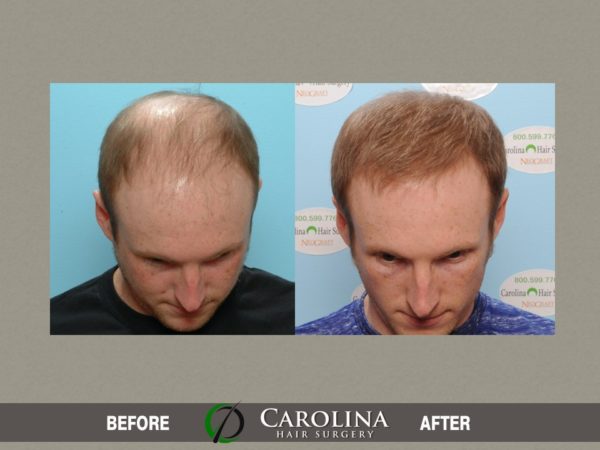 Hair Transplant Before & After Photos